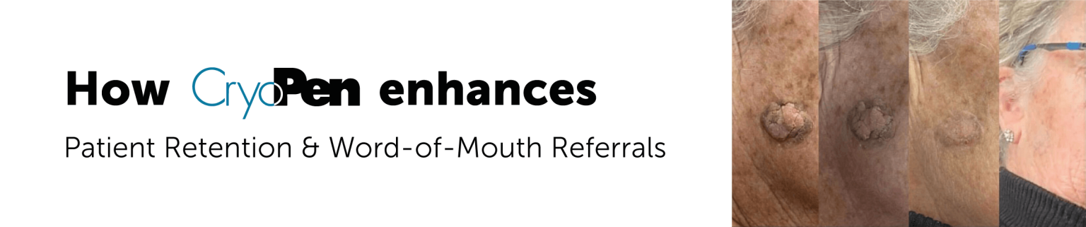 CryoPen: Your Must Know Guide - Cryopen